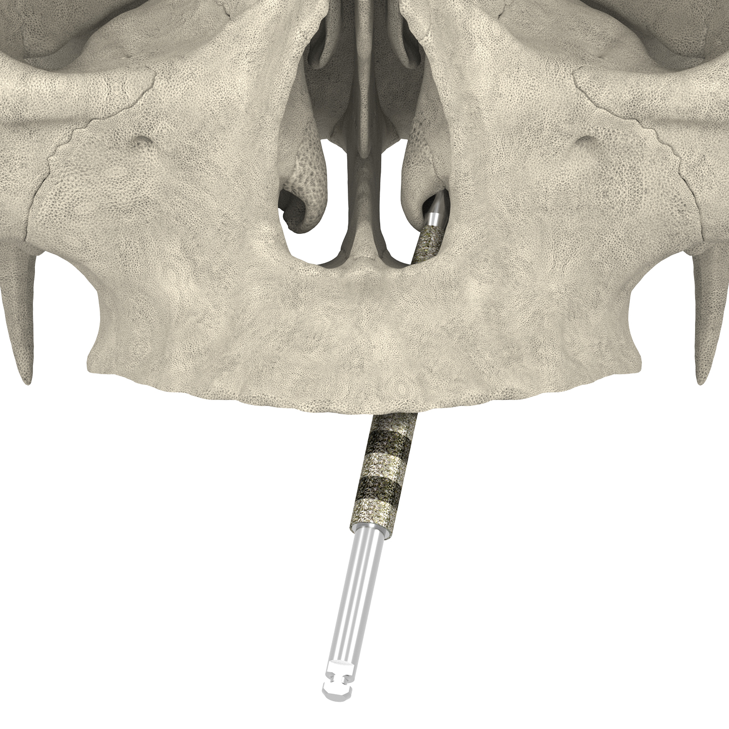 JDNasal TranZ Drill Cutter for trans-sinus implants
