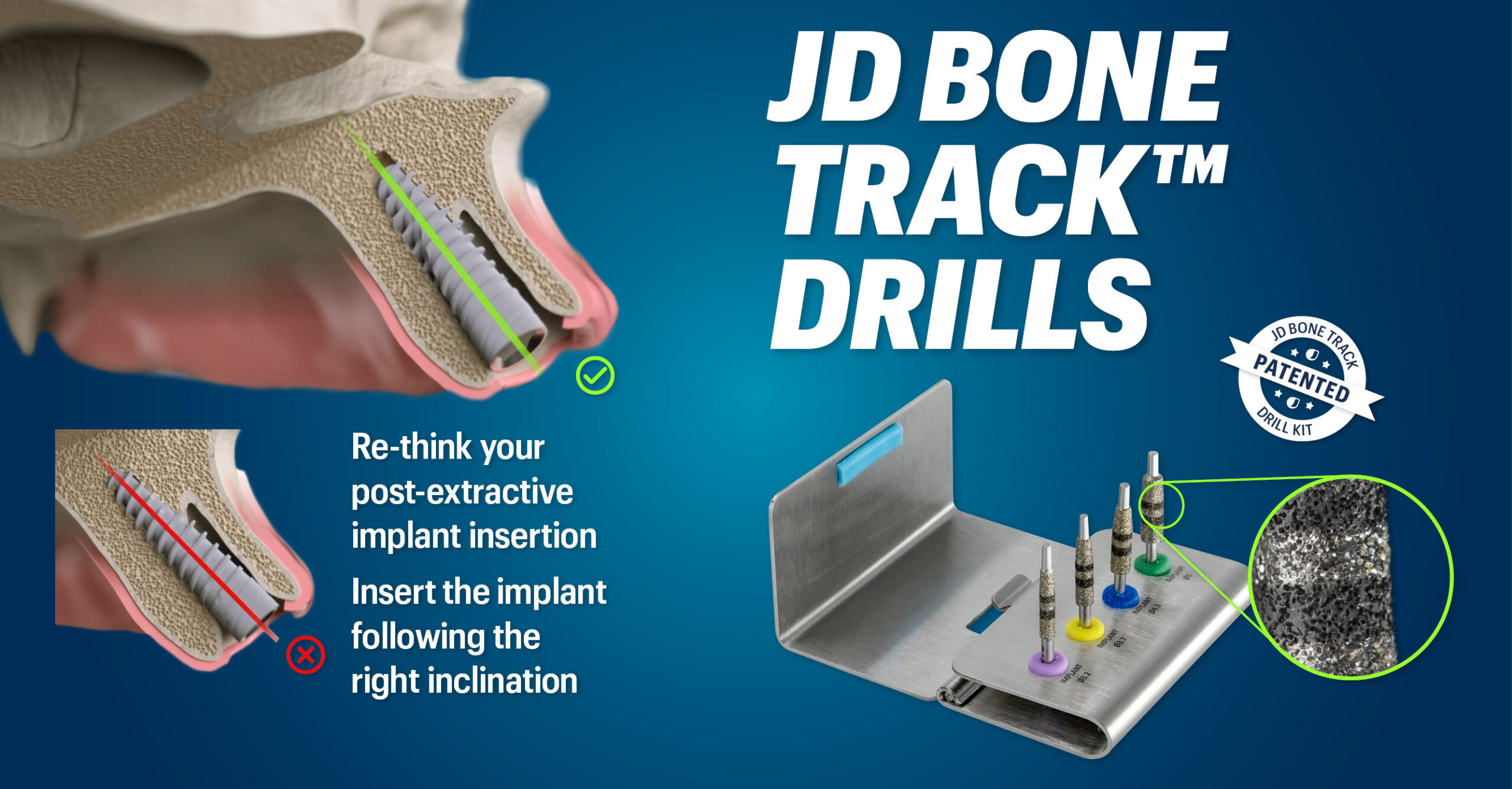 JD PROMO - JD Bone Track™ Drills - JDentalCare
